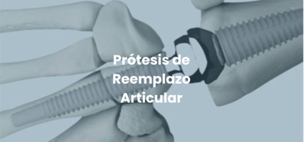 Prótesis de Reemplazo Articular: Soluciones Avanzadas para Muñeca ...